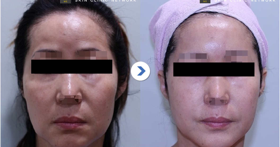 Renewme Skin Clinic: Restoring Facial Volume = Restoring Youth Renewme Skin Clinic: Restoring Facial Volume = Restoring Youth