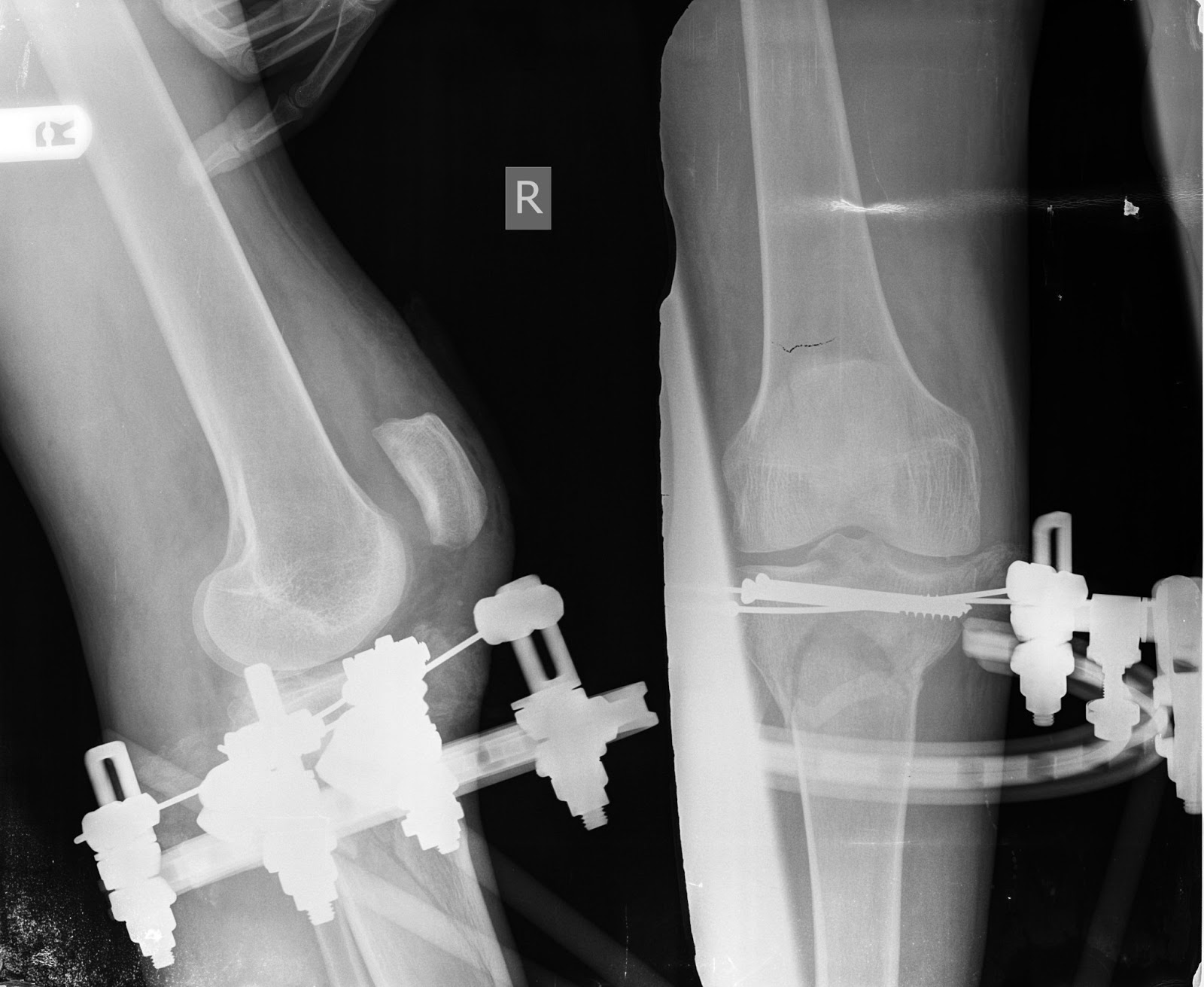Tibial plateau fracture swelling - jeryev