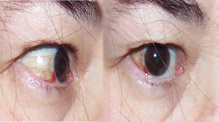 Tive uma hemorragia ocular, e agora?