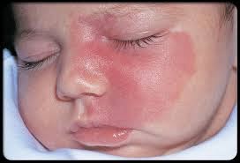 new mum and new baby: Spots and freckles skin in newborns