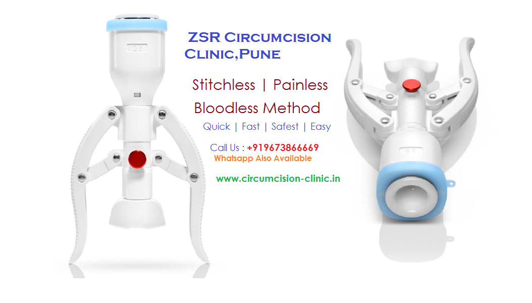 Stitchless ZSR Circumcision