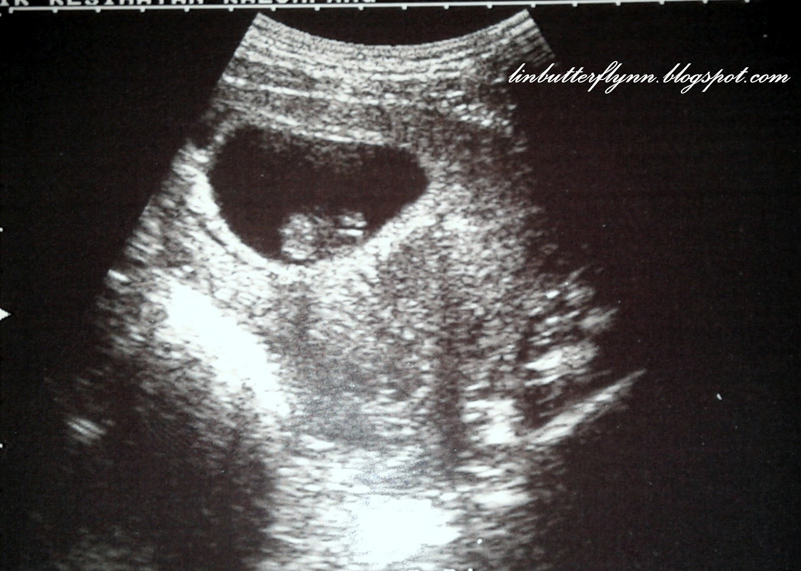 butterfLYNN: baby scan for the first time!