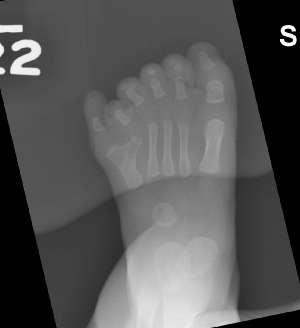 Extra Digits | Congenital Hand and Arm Differences | Washington ...
