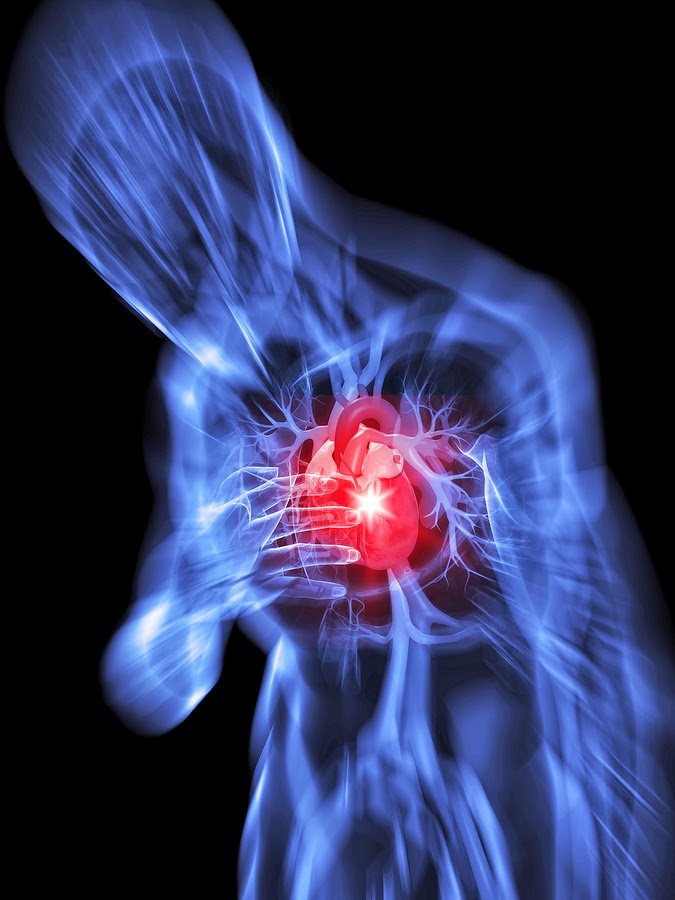 Info Sehat dan Fit: Serangan Jantung - Infark Miokardium