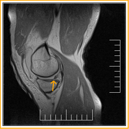 O'Donoghue's unhappy triad -MRI - Sumer's Radiology Blog