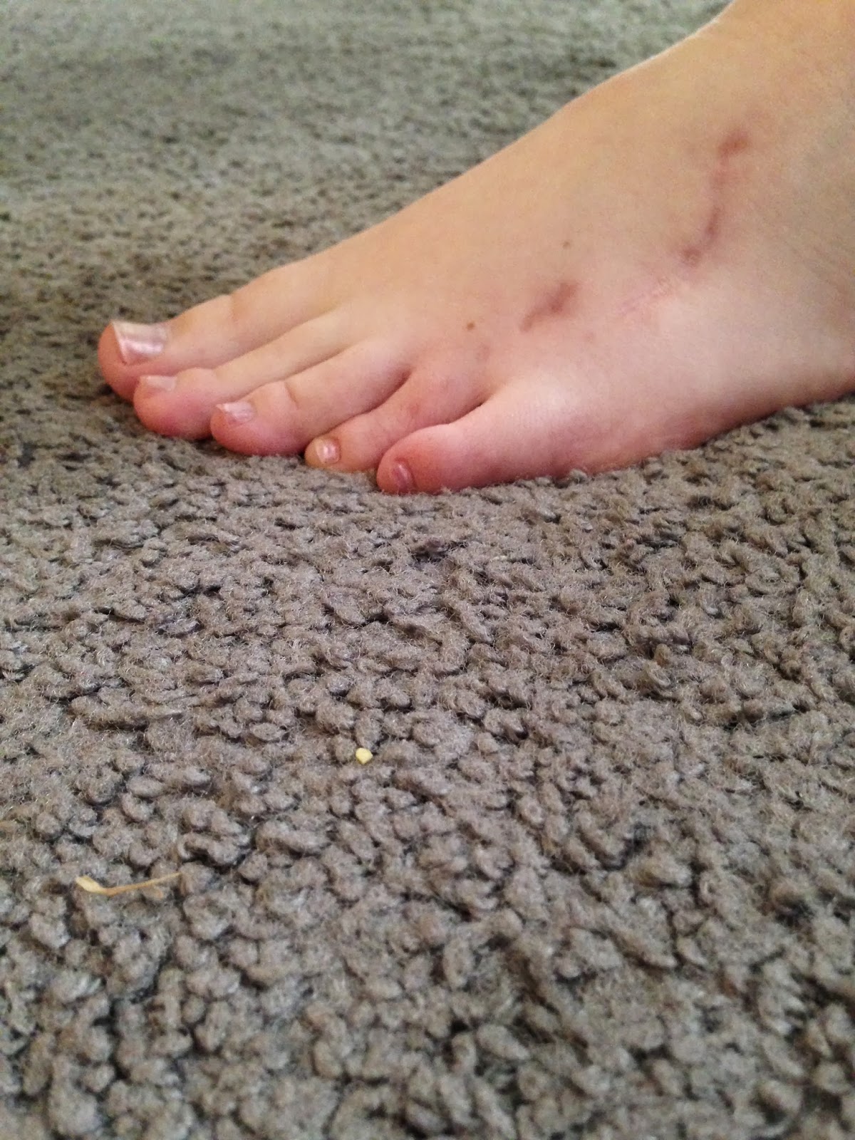 My Journey through Brachymetatarsia Surgery!: January 2014