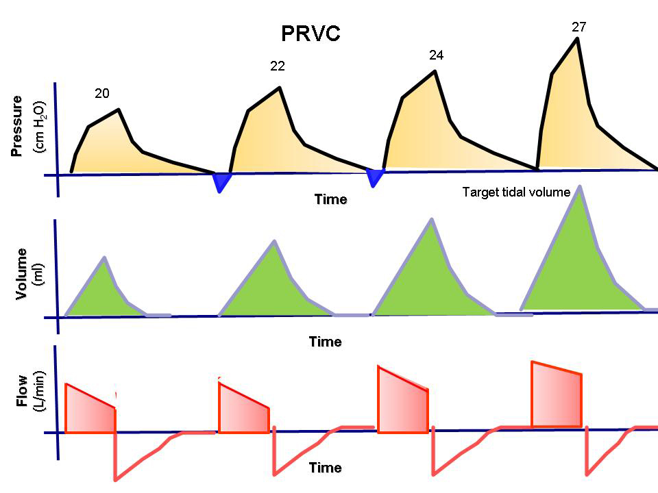 EmergenMed Health Blog: Ventilación mecánica