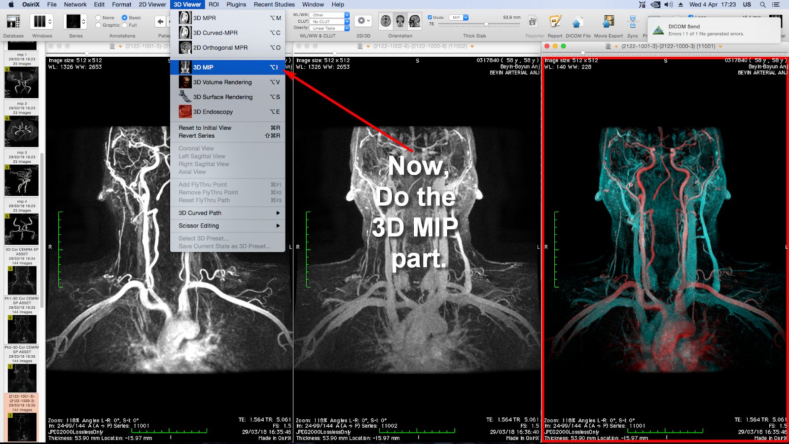 Nevit's blog: How to Create Color MR Angiography using Osirix and Color ...