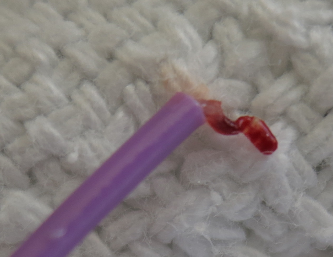 jm's Adventure with Multiple Myeloma: 2nd ASCT - Day 26 - PICC Line ...