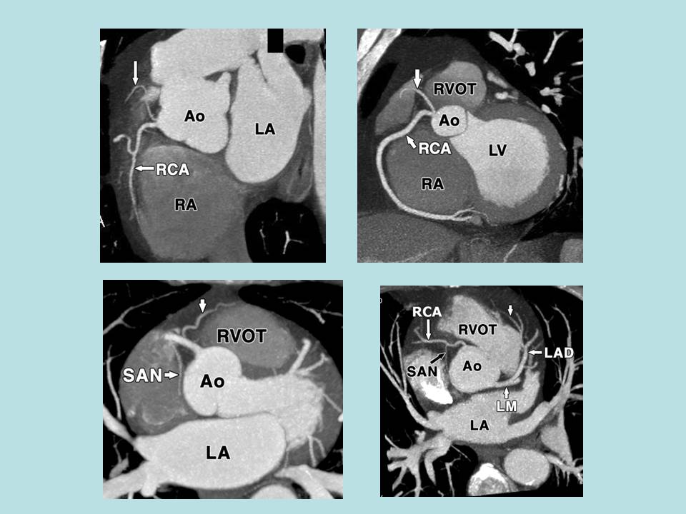 The Pump and the Tubes: The Third Coronary Artery? (the conus artery)