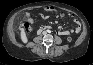 Radiology Station: Omental Infarction