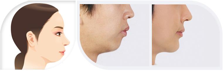 Eyelid Surgery Legend Dr. Kim Byung Gun: [BK Plastic Surgery Hospital ...