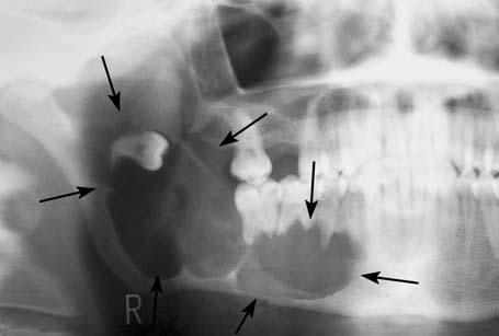 Dentistry and Medicine: Impacted Mandibular 3rd Molar Classification ...
