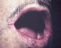 Semiología Quirúrgica: EXPLORACION DE LA CABEZA