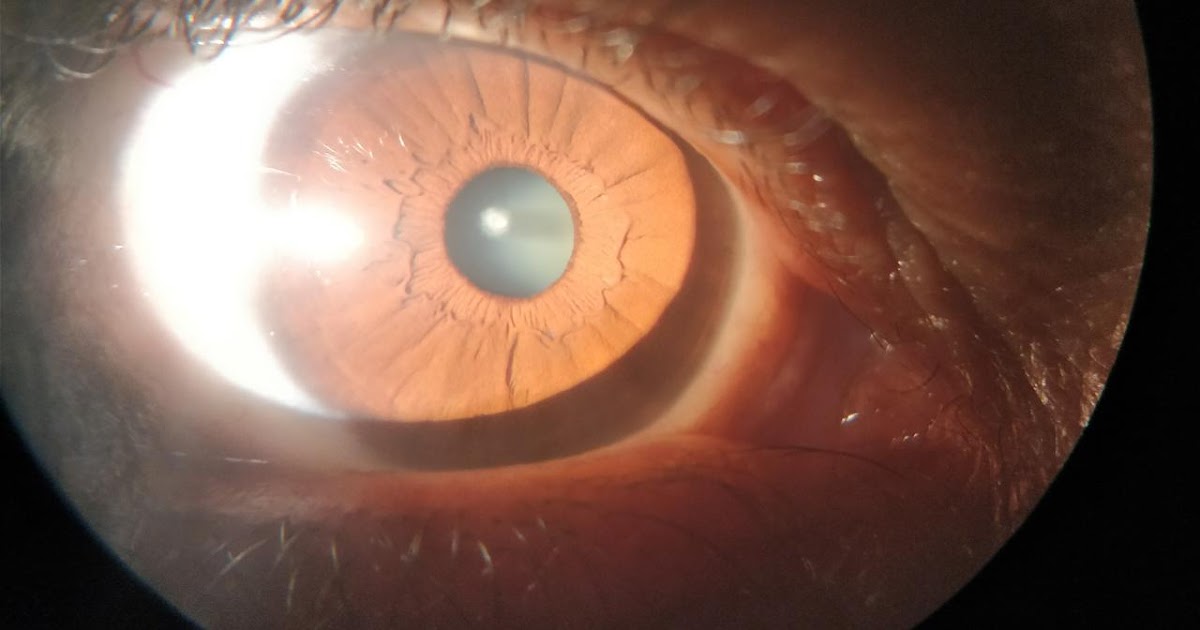 Medicowesome: MIL: Polar cataract