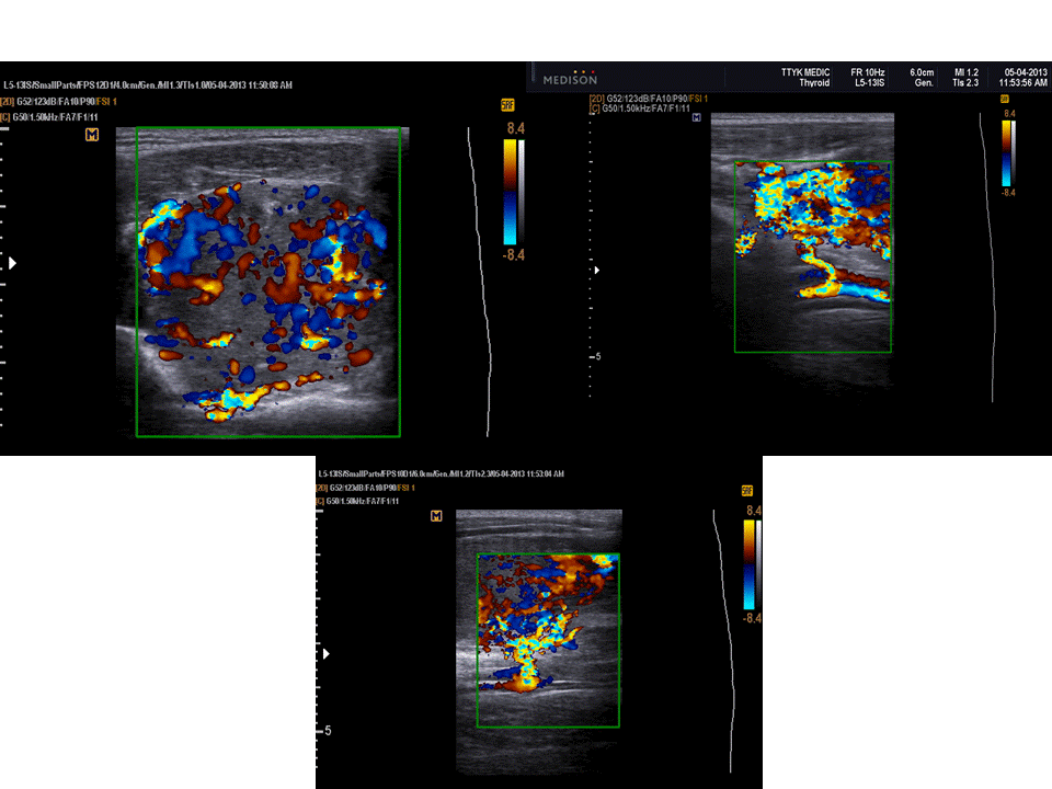 VIETNAMESE MEDIC ULTRASOUND: CASE 183: LEFT ARM MASS, Dr PHAN THANH HẢI ...