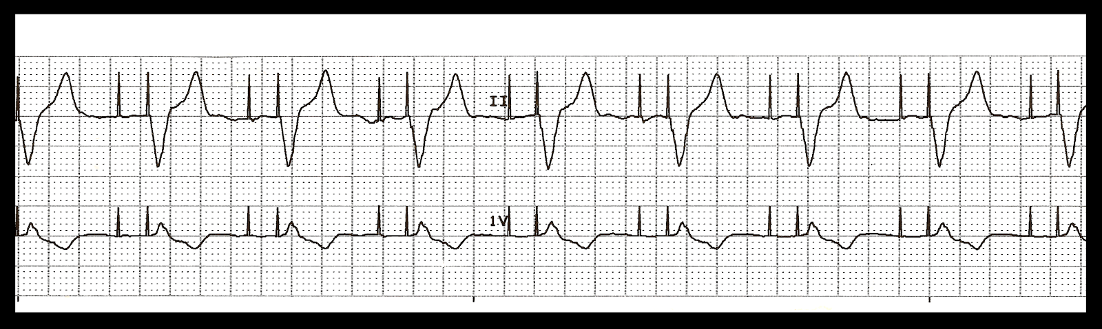 EKG Rhythm Quiz 244