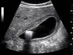 DR. JUAN HERNÁNDEZ ORDUÑA. : Colecistitis