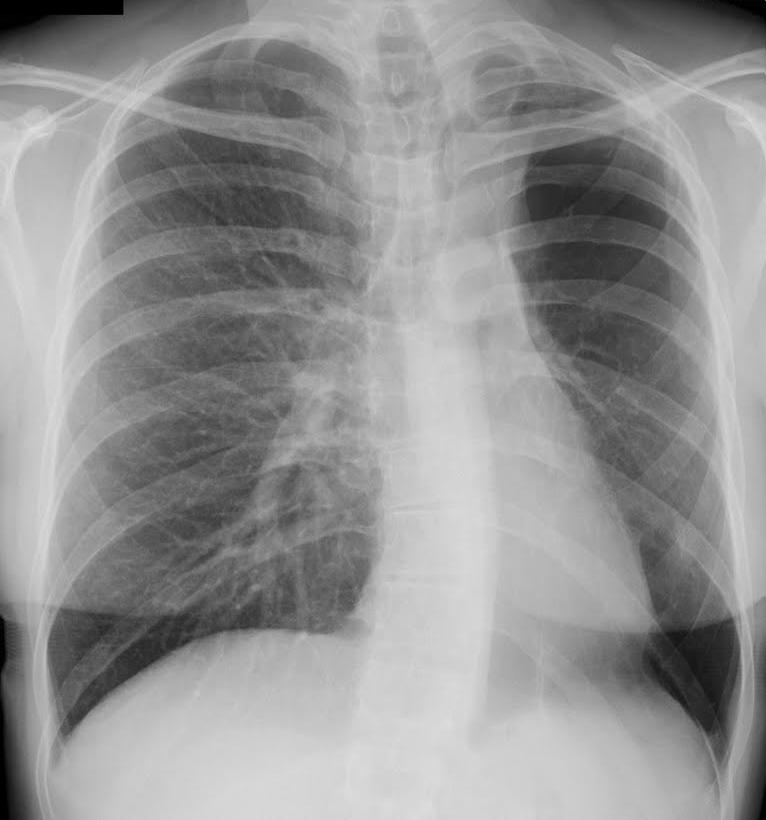 ABC Radiology Blog: Swyer-James Syndrome (SJS)