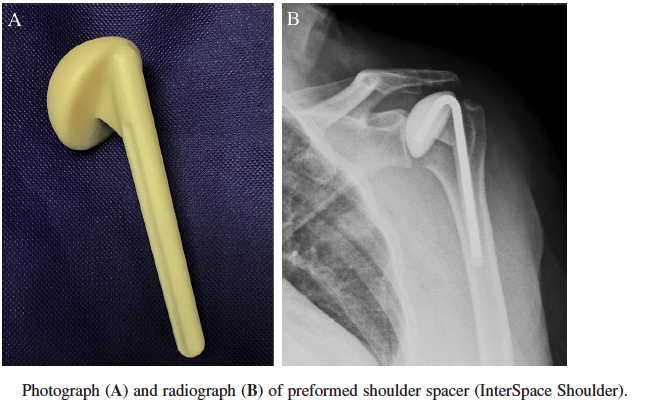 UW Shoulder and Elbow Academy: Are antibiotic spacers a benign ...