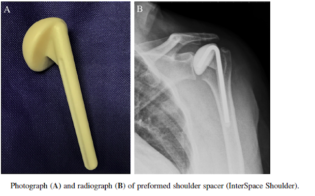 UW Shoulder and Elbow Academy: Are antibiotic spacers a benign ...