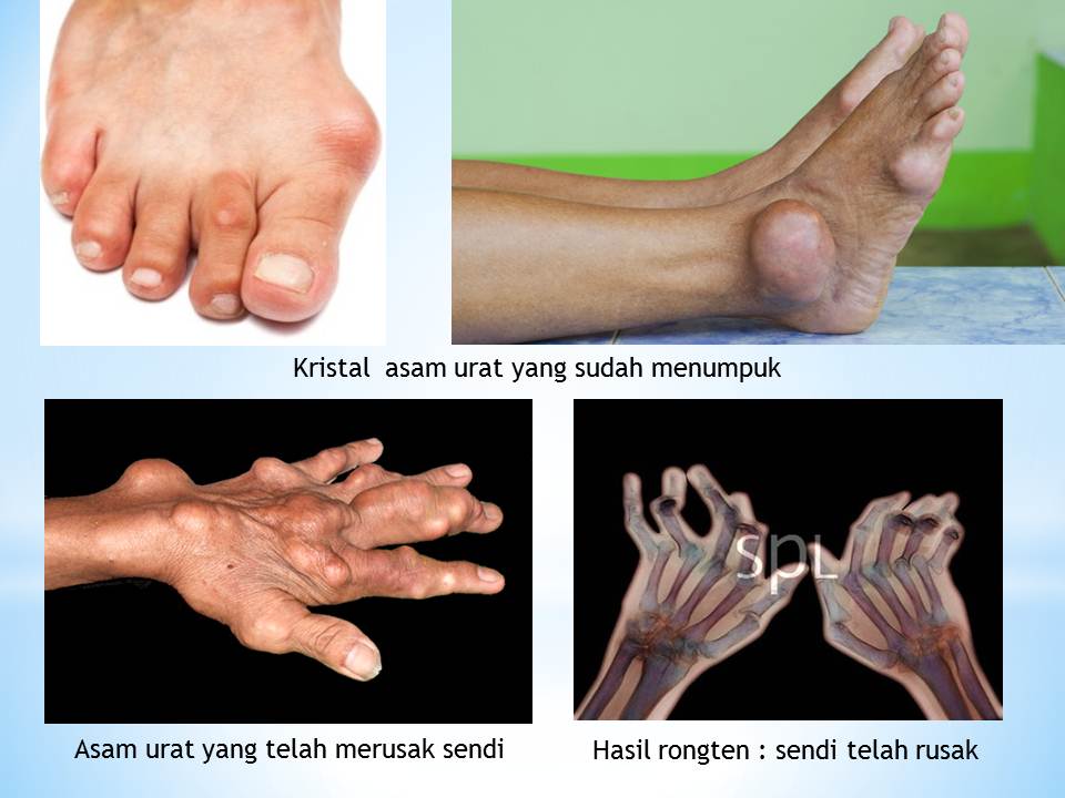 BAHAYA ASAM URAT & TIPS MENGOBATI - Preventive Health Solution