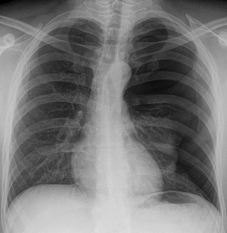 When Pneumothoraces Become Cyclic - AAEM/RSA