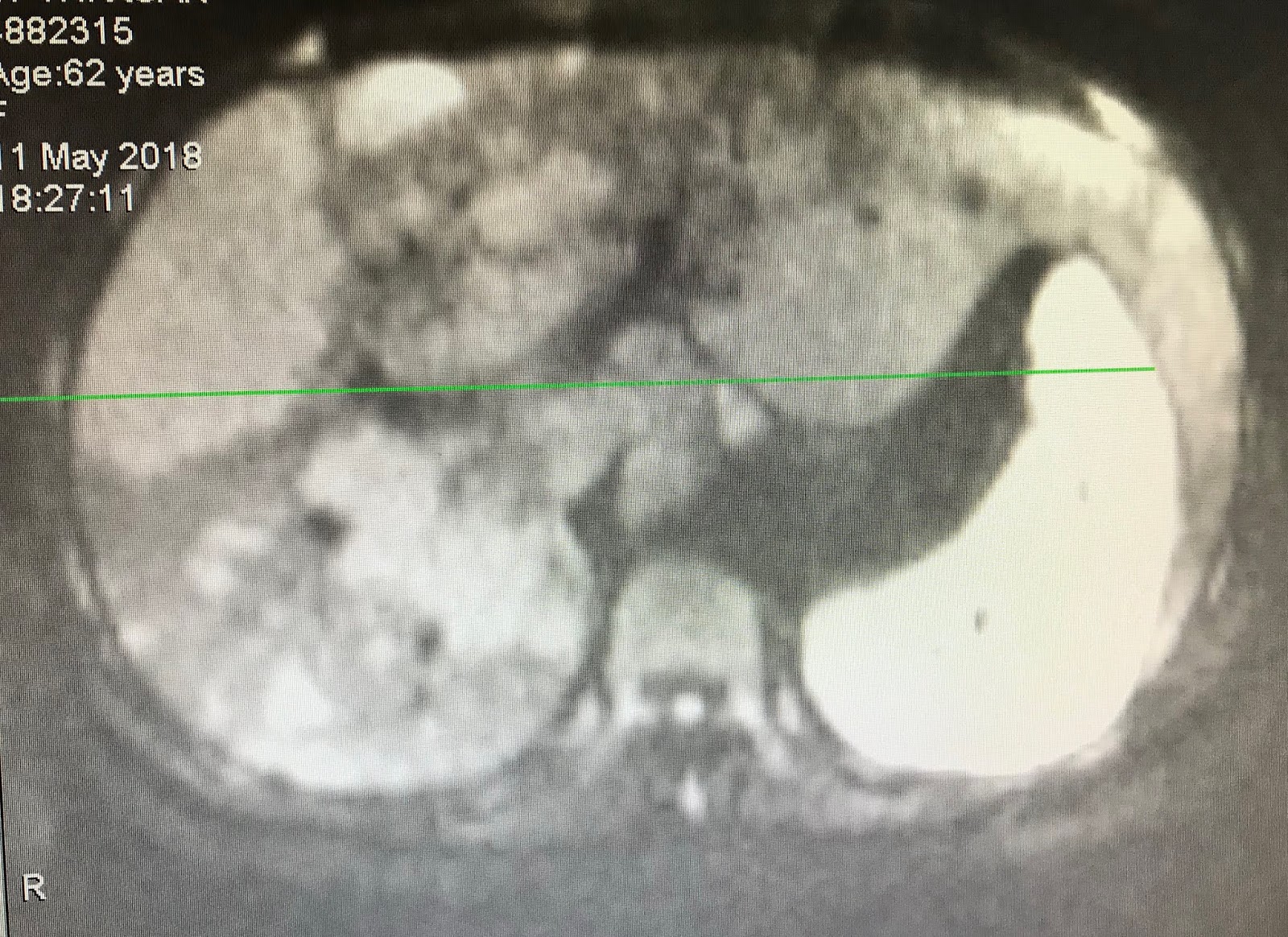 VIETNAMESE MEDIC ULTRASOUND: CASE 494: PRIMARY LIVER LYMPHOMA (PLL),Dr ...