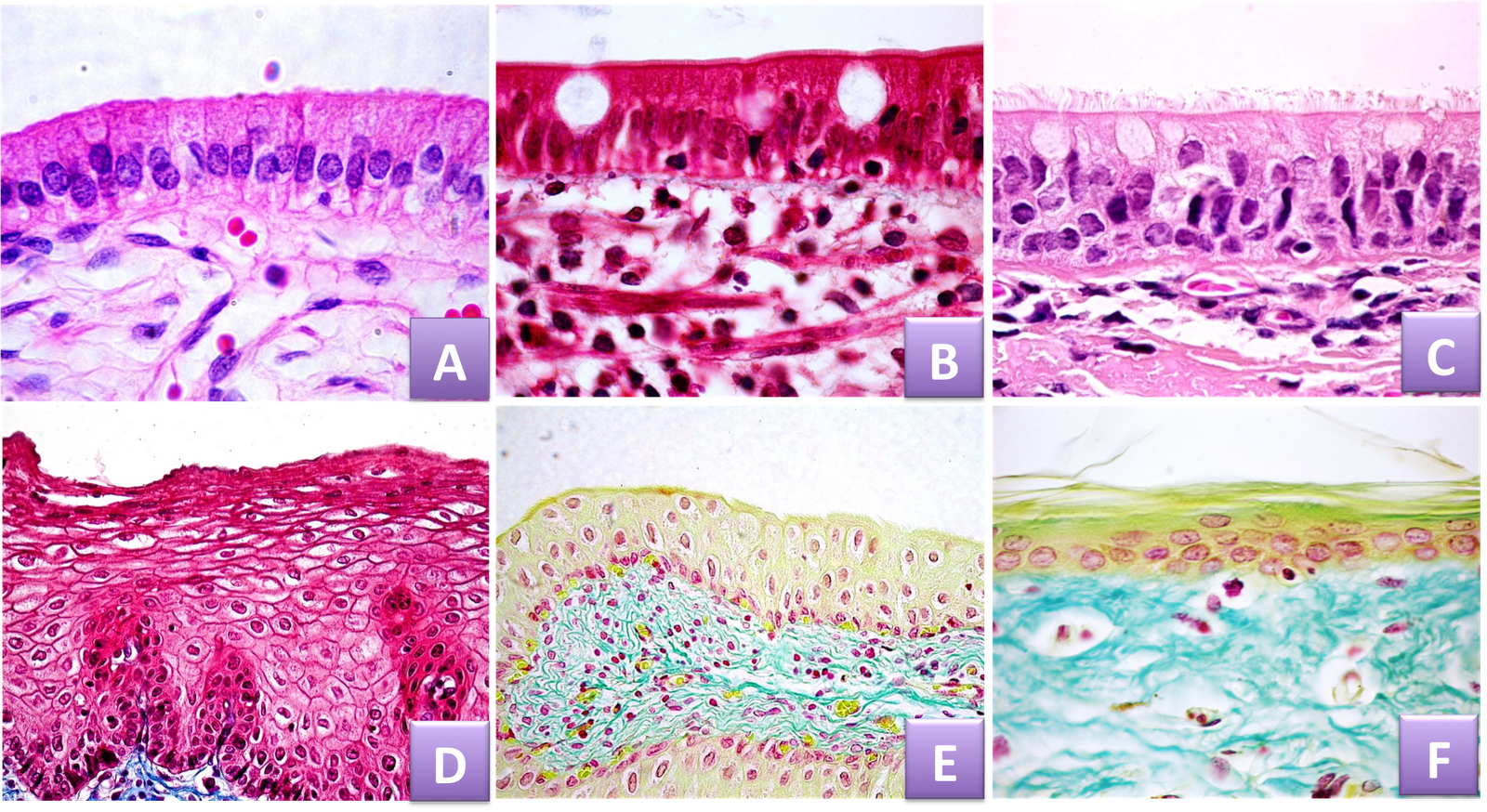 Epitélio Aceto Branco Tênue Grau 1 - BRAINCP