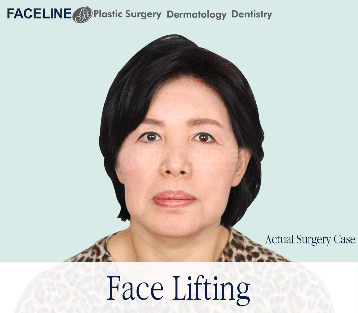 Faceline's full face lifting for rejuvenation!