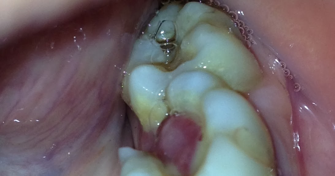 Diagnosing Oral & Maxillofacial Pathologies in My Residency: CHRONIC ...