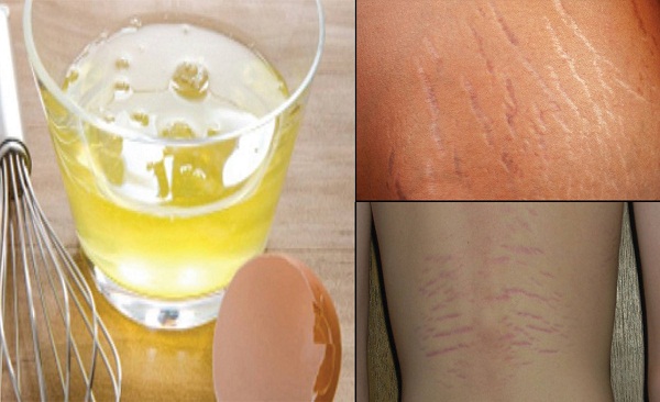 Pentru Suflet: Albusul va scapa de vergeturi!