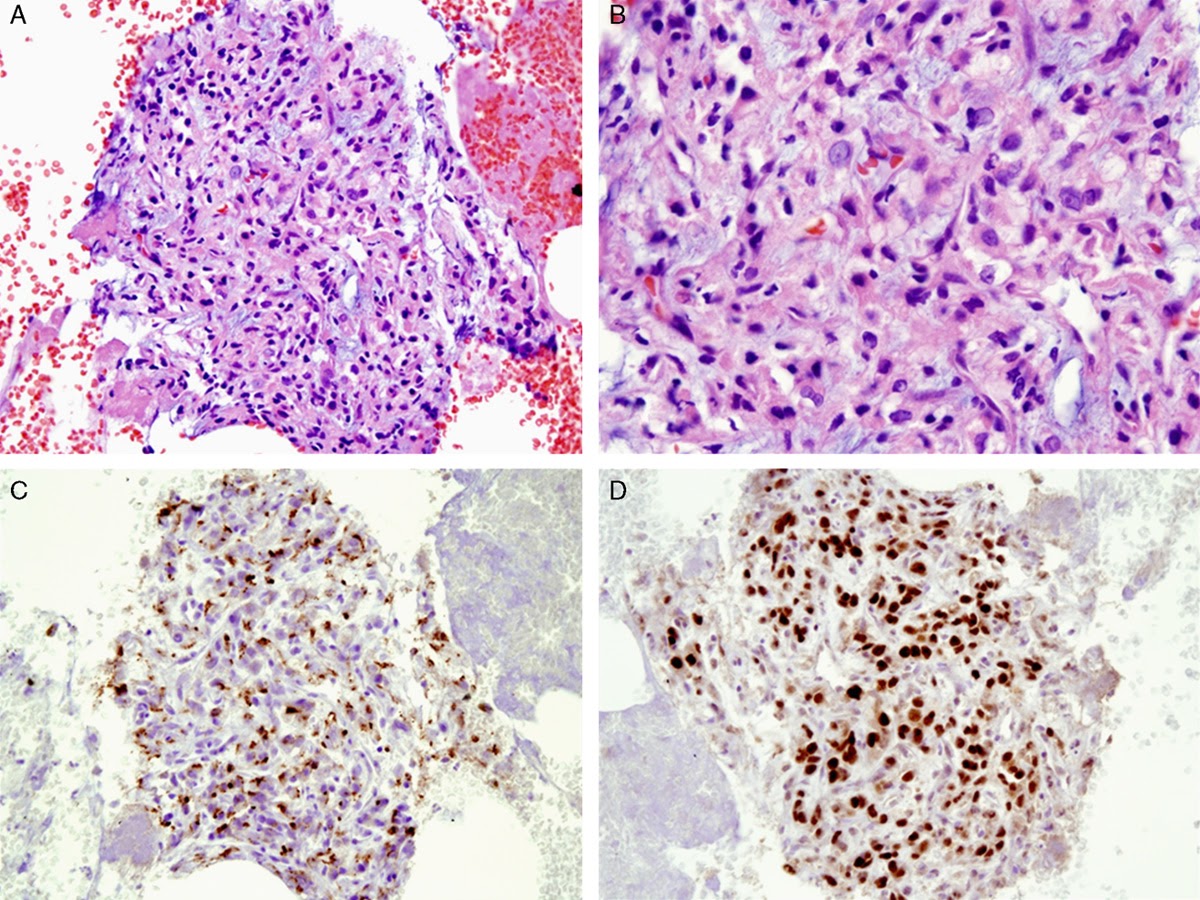 PATHfinder: International Society of Urological Pathology Consensus ...