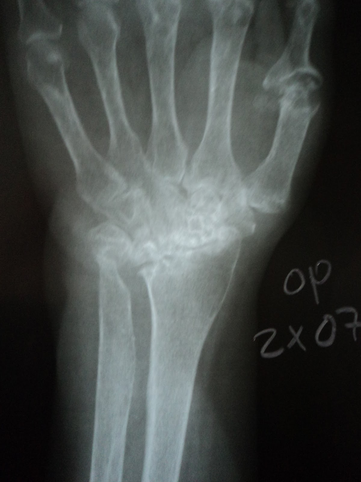 OSSA CARPALIA ©: Reparación de tendones extensores en artritis reumatoide