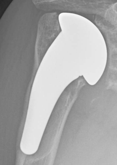 Shoulder Arthritis / Rotator Cuff Tears / Shoulder Pain : Short humeral ...