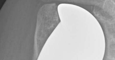 Shoulder Arthritis / Rotator Cuff Tears / Shoulder Pain : Short humeral ...