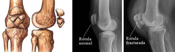 PEDIAFX: Fracturas en rodilla