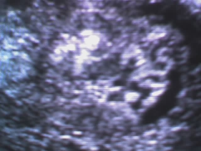 ULTRASSONOGRAFIA - Dr. Walter Lustosa Jr.: Mola Invasora