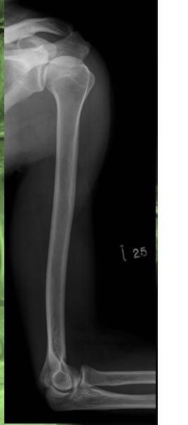 Radiología Silva2: Humero Lateral