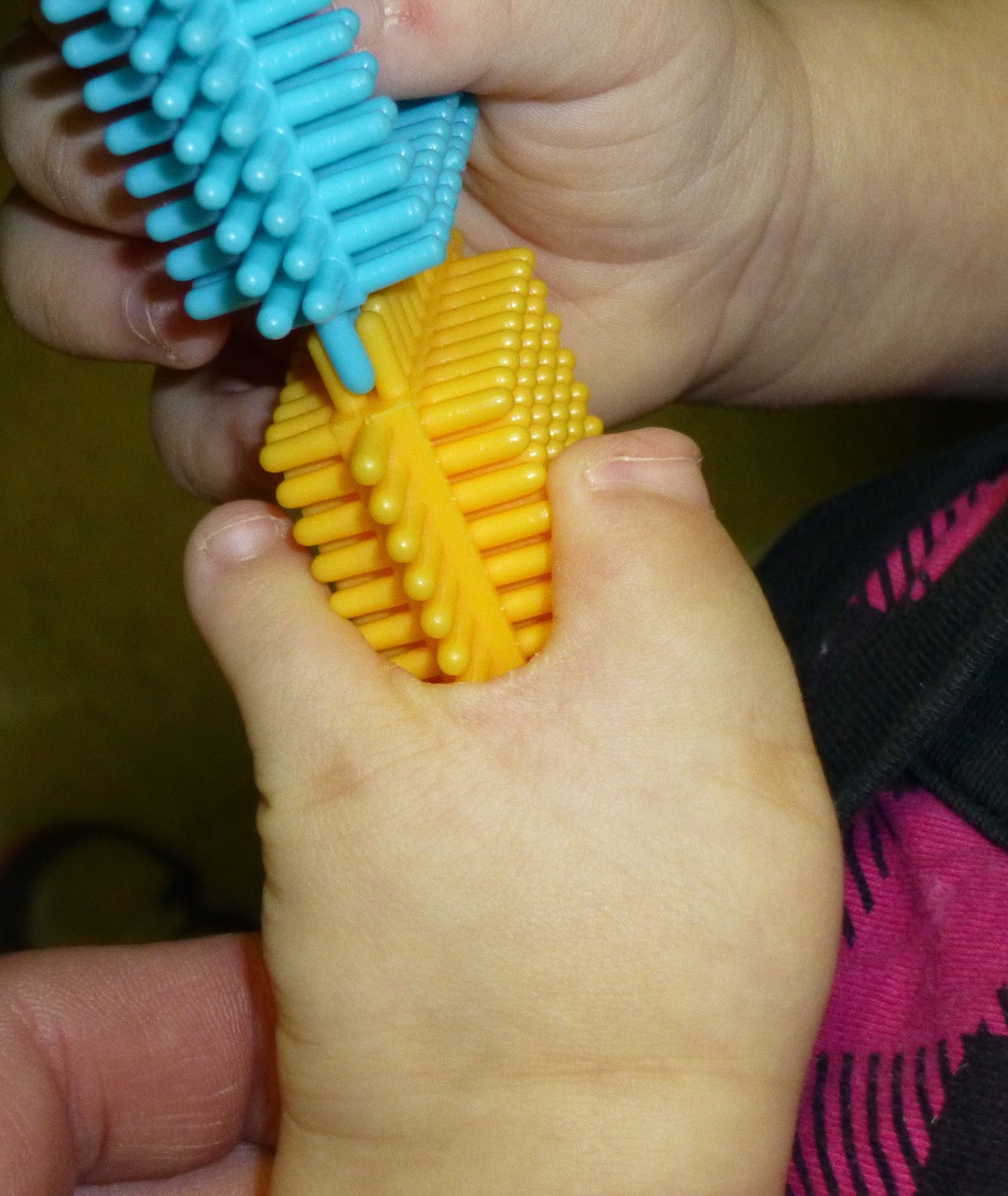 Central Deficiency with 2-3 fingers | Congenital Hand and Arm ...