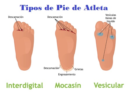 DOCTORCITO: Pie de Atleta