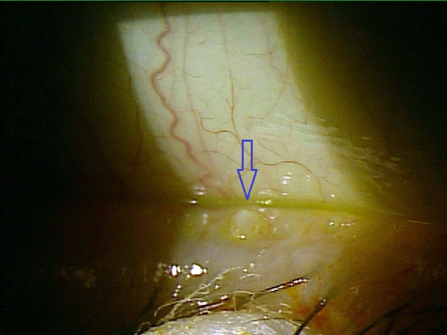 dry eye knowledge: Meibomian Gland Dysfunction (MGD) and dry eye