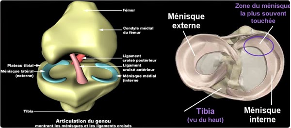 Blog 75: Infos santé : Sport et Santé-Chirurgie du ménisque