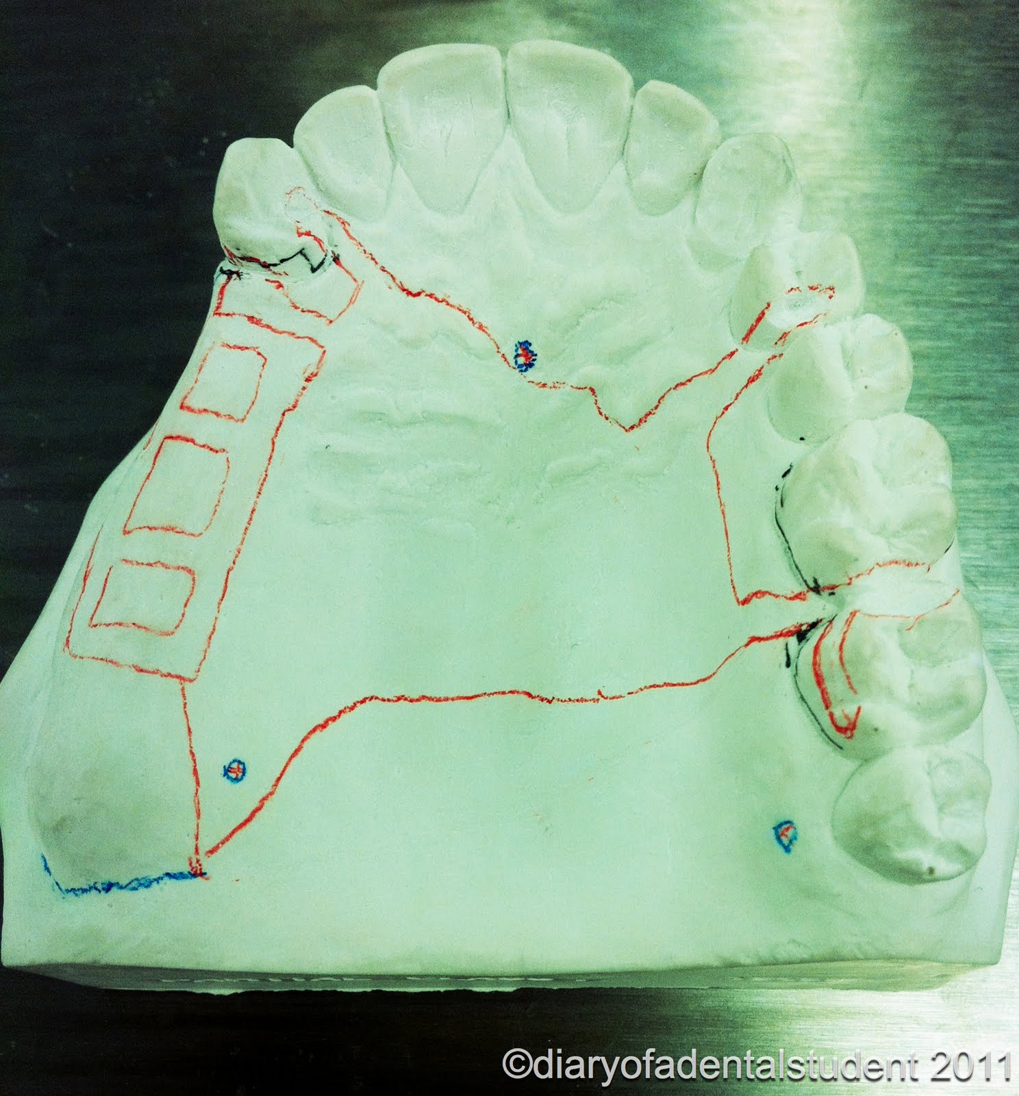diary of a dental student: RPD's