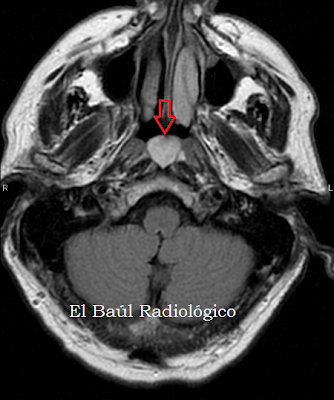 El Baúl Radiológico: QUISTE DE TORNWALDT. BURSA RINOFARÍNGEA (Tornwaldt ...
