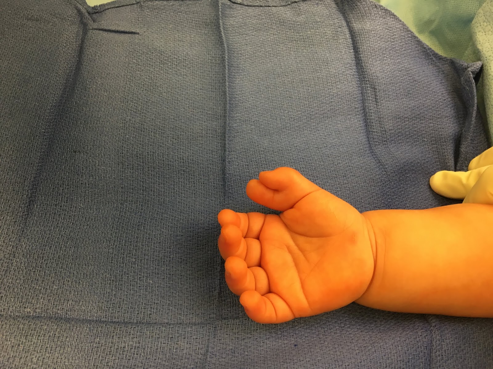 Extra Thumb Reconstruction | Congenital Hand and Arm Differences ...