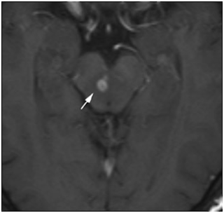 NeuroAnatomía Dr. William Ganem: Romboencefalitis por Listeria ...