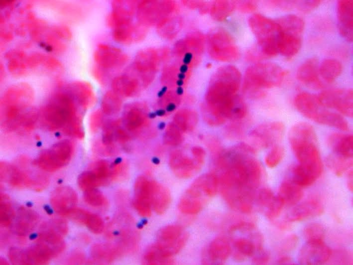 Fun With Microbiology (What's Buggin' You?): Streptococcus pneumoniae