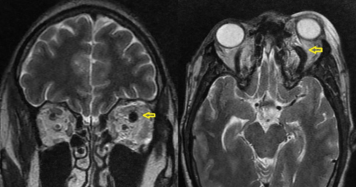 Neuroradiology Cases: Superior Ophthalmic Vein