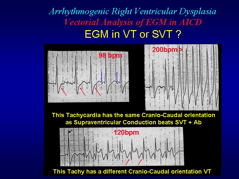 ARVCsGF: Vectorial interpretation of VT/SVT signals stored in the ICD